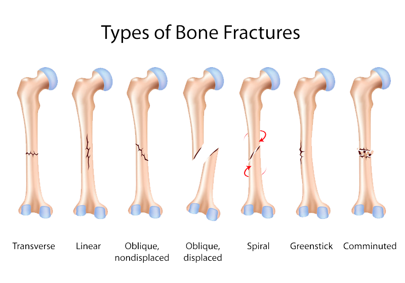 Broken Bones Dr William Sima