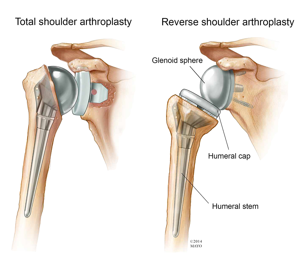 Shoulder Surgery Templeton CA Dr William Sima MD